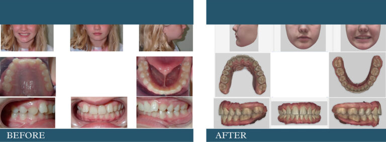 Smile Gallery - Berman & Masoud Orthodontics